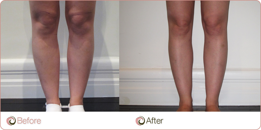 Legs Liposuction | Calf Liposuction | Knee Liposuction Legs Liposuction | Calf Liposuction | Knee Liposuction