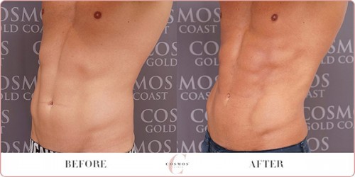 Vaser Hi Definition Liposuction | HD Liposuction